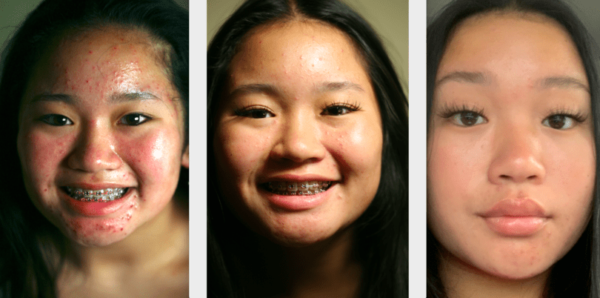 Acne Treatment in Woodlands TX | Dermanature Inc