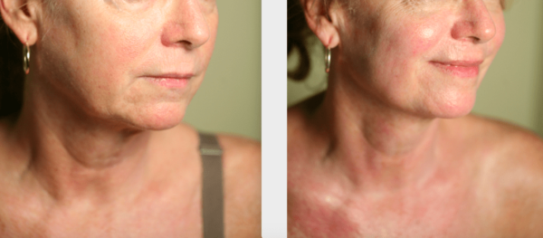 Laser Muscle Toning Woodlands Texas | Dermanature Inc