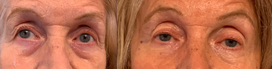 FACIAL FILLERS SERVICES CONROE TEXAS | DERMANATURE INC