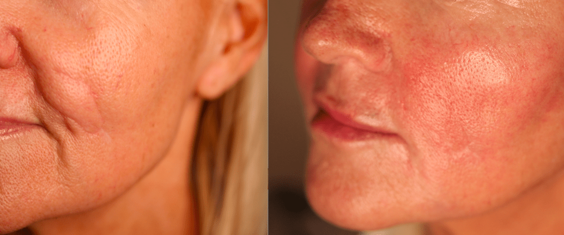 FACIAL FILLERS SERVICES CONROE TEXAS | DERMANATURE INC